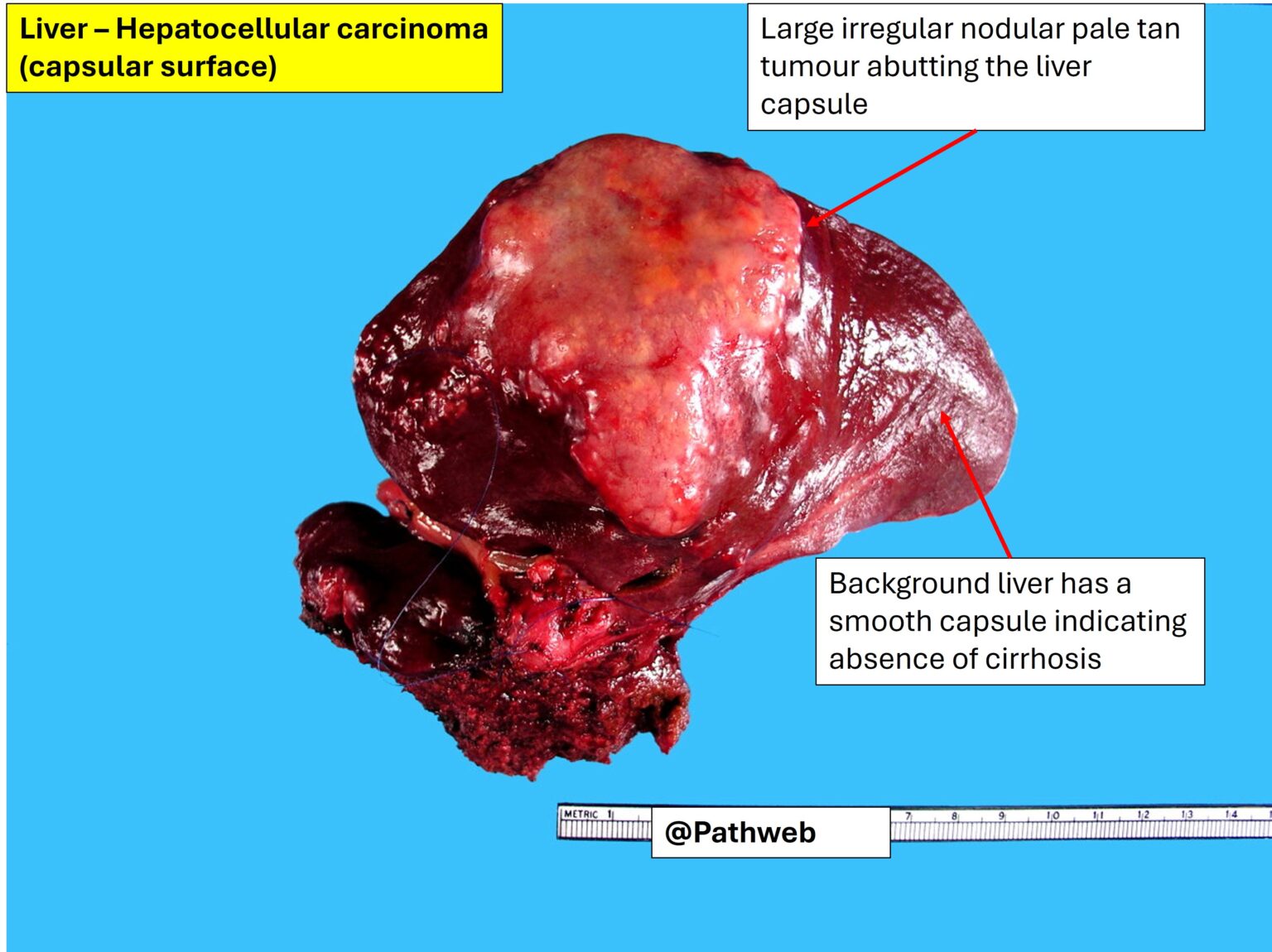 Liver – Hepatocellular Carcinoma – NUS Pathweb :: NUS Pathweb