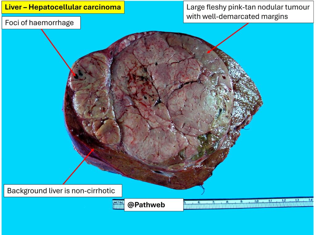 Liver – Hepatocellular Carcinoma – NUS Pathweb :: NUS Pathweb