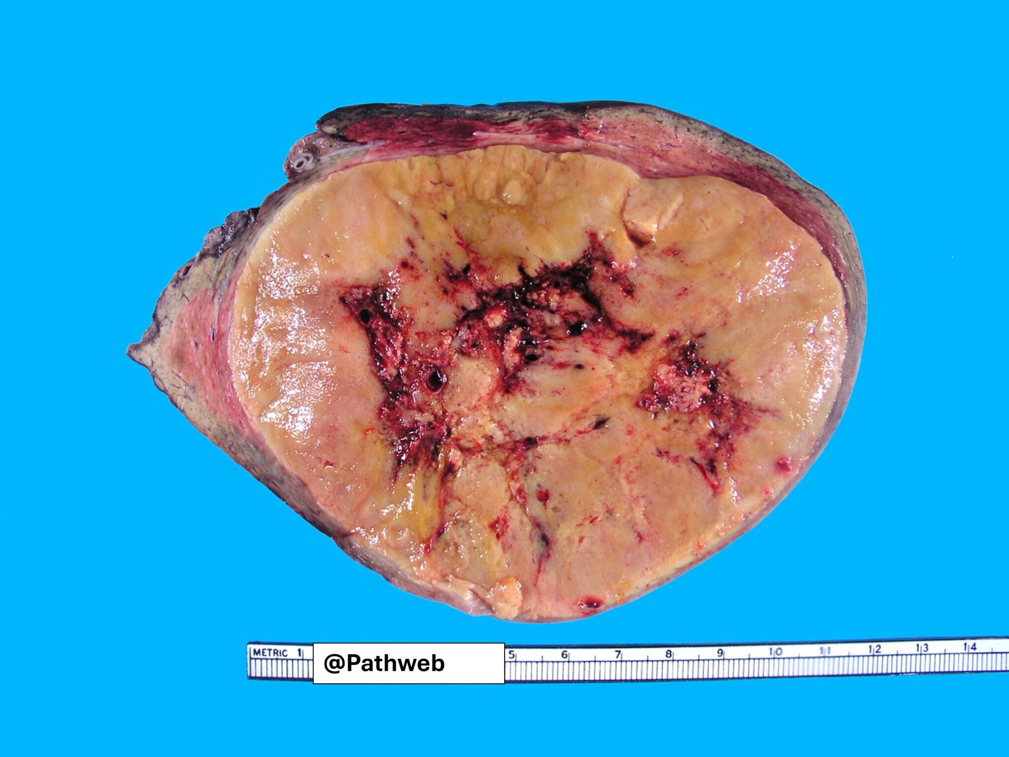 Liver – Hepatocellular Carcinoma – NUS Pathweb :: NUS Pathweb
