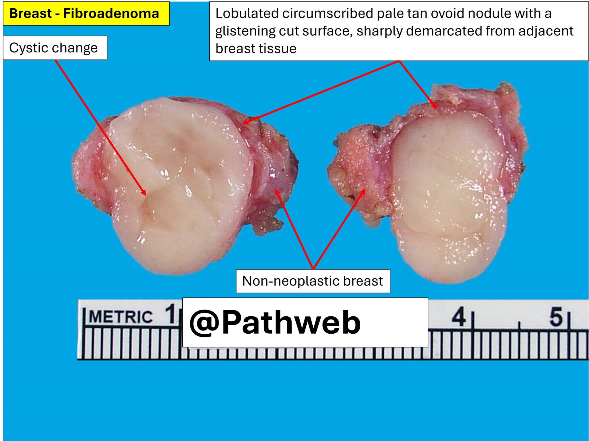 Breast – Fibroadenoma – NUS Pathweb :: NUS Pathweb