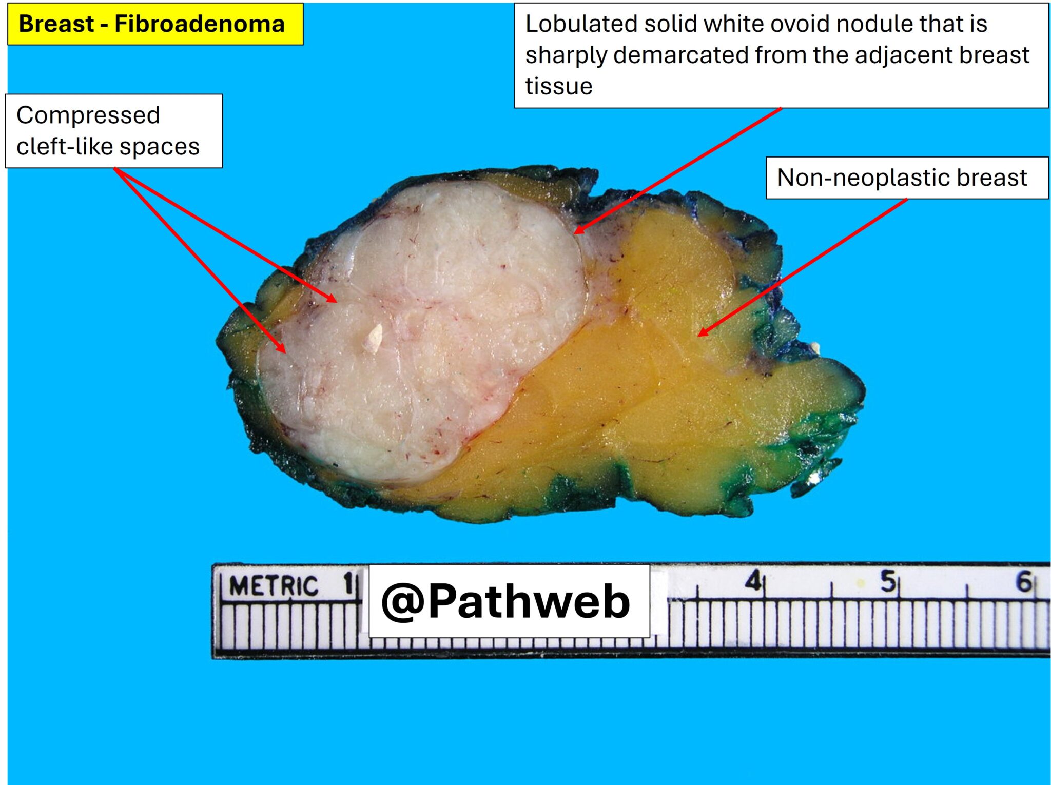 Breast – Fibroadenoma – NUS Pathweb :: NUS Pathweb