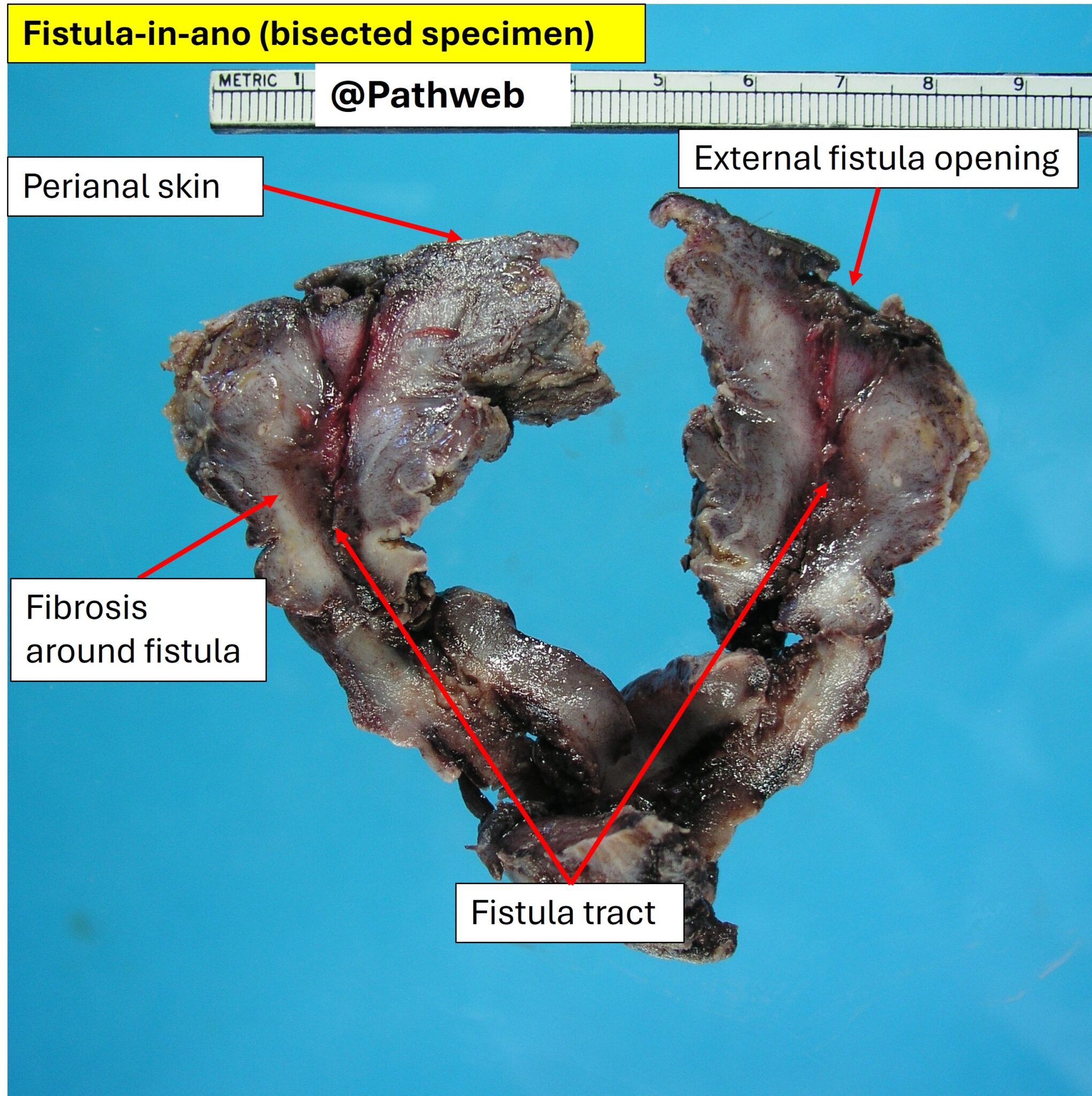 Skin – Fistula in Ano – NUS Pathweb :: NUS Pathweb