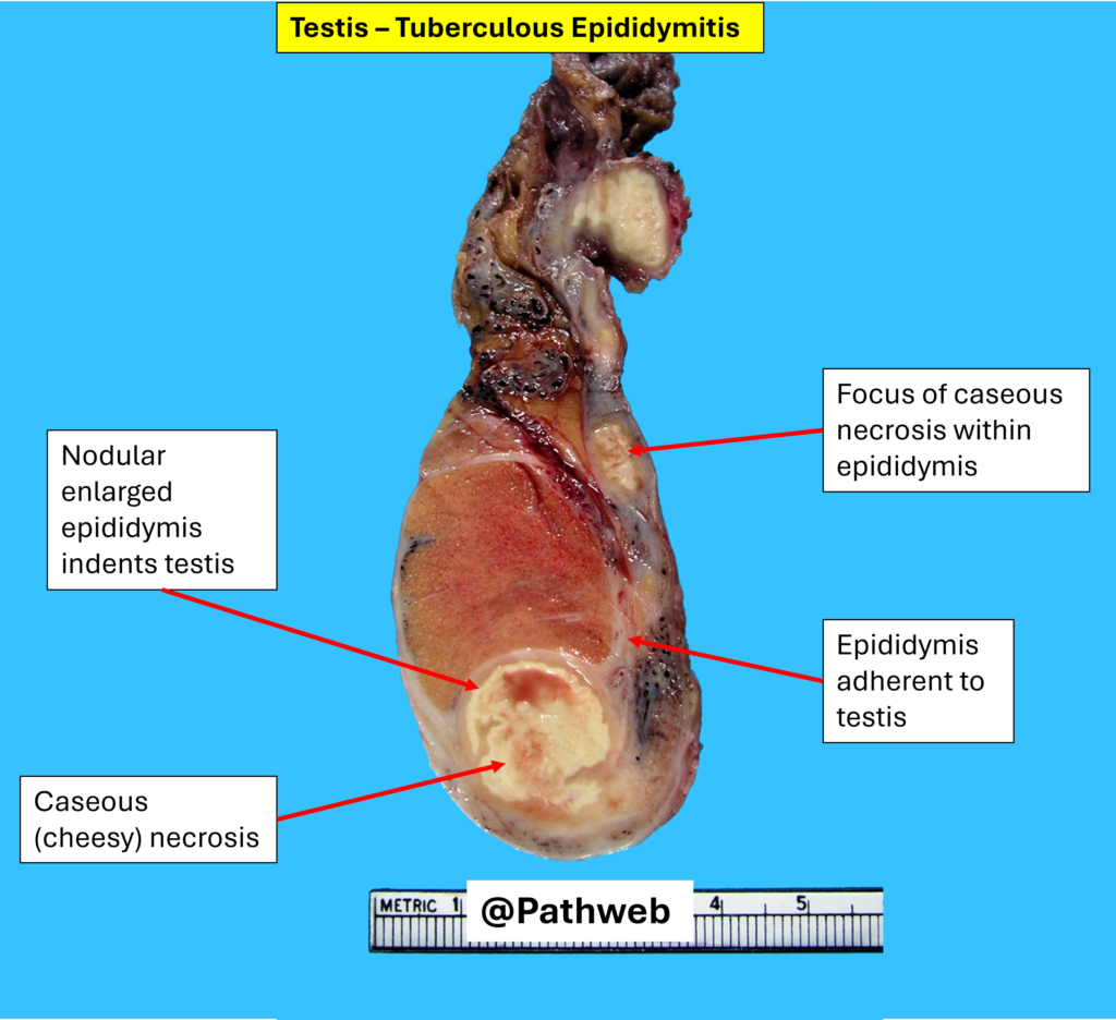 Testis – Tuberculous Epididymitis – NUS Pathweb :: NUS Pathweb
