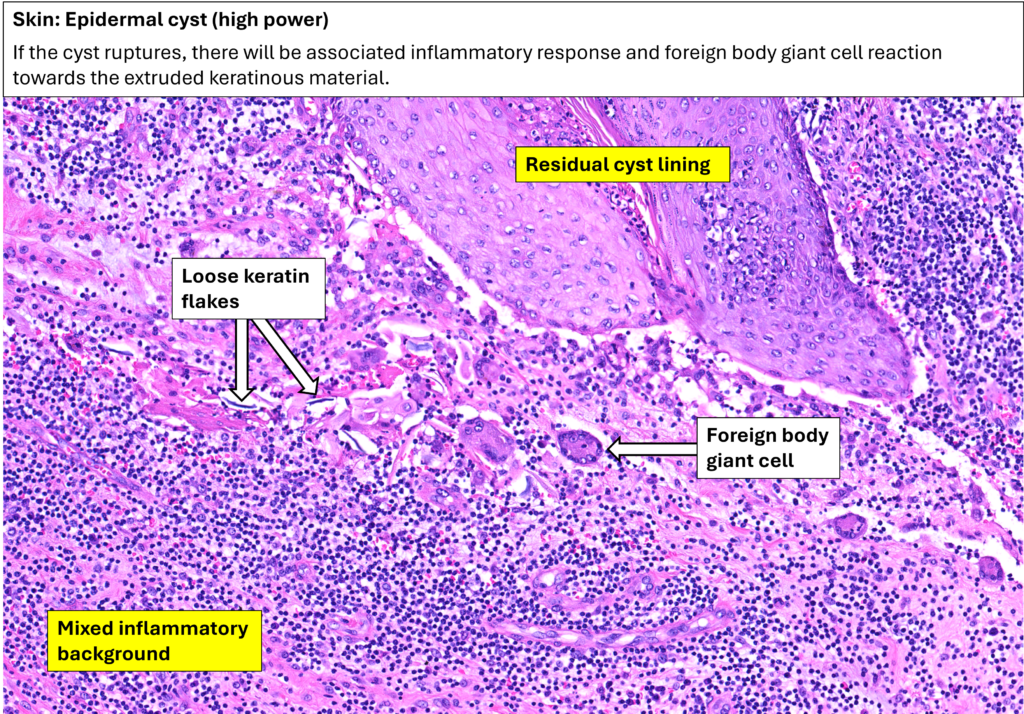 Skin – Epidermal cyst – NUS Pathweb :: NUS Pathweb