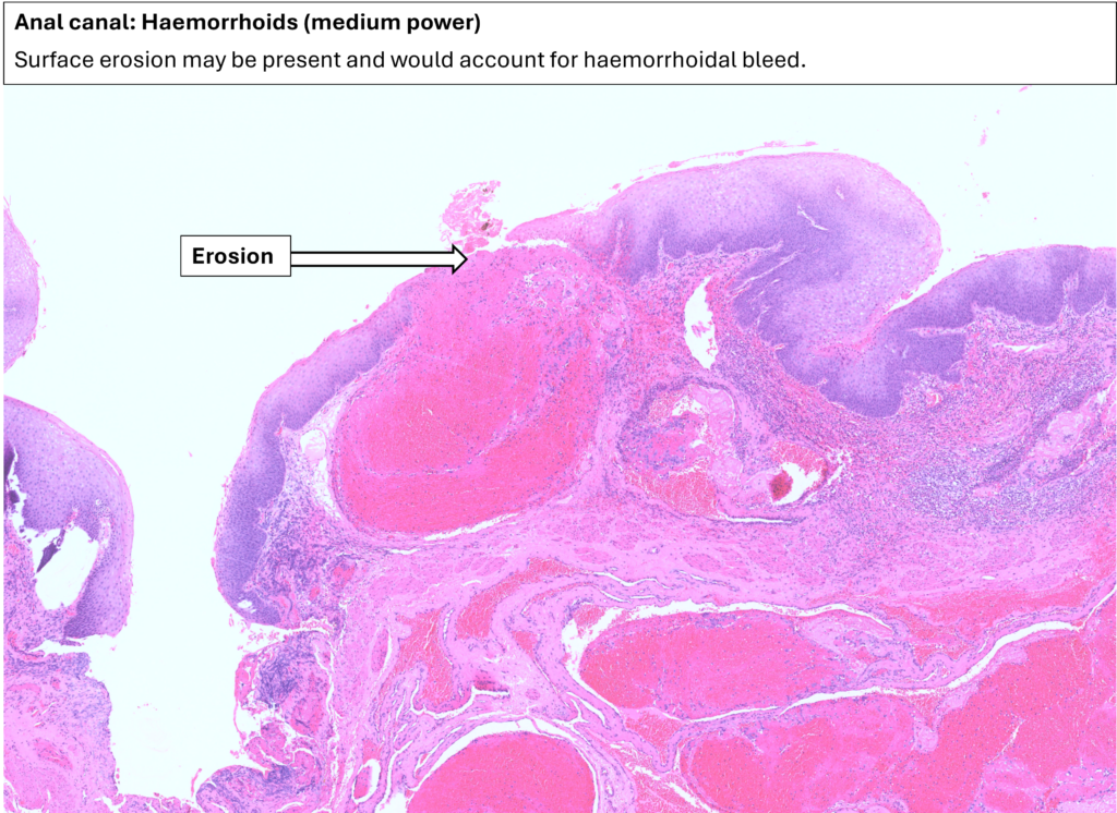 Anal canal – Haemorrhoids – NUS Pathweb :: NUS Pathweb