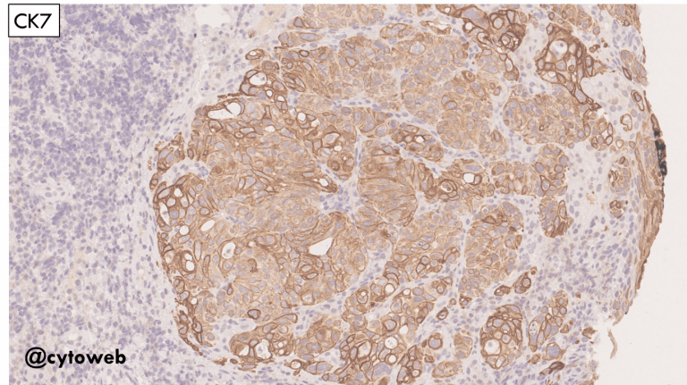 Mystery cases – Thyroid 3 – NUS Pathweb :: NUS Pathweb