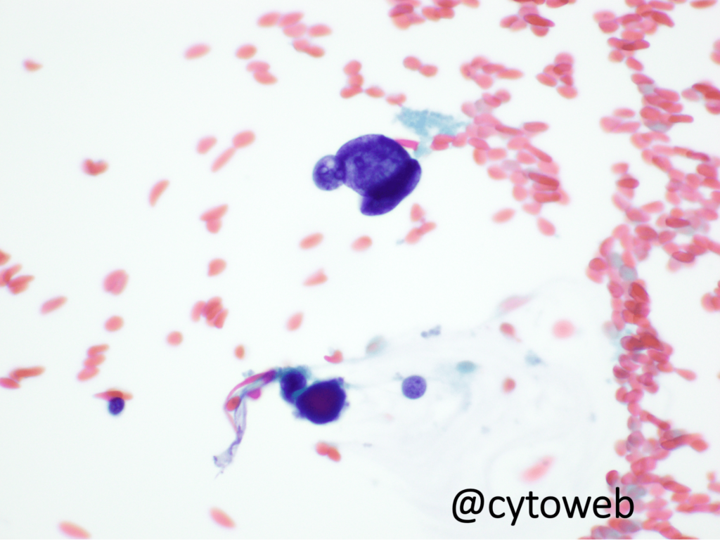 Mystery cases – Thyroid 1 – NUS Pathweb :: NUS Pathweb