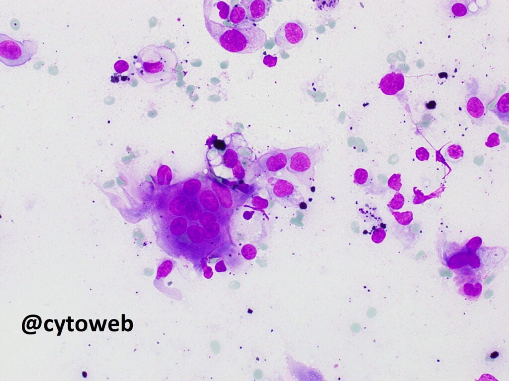 Mystery cases – EUS-FNA 6 – NUS Pathweb :: NUS Pathweb