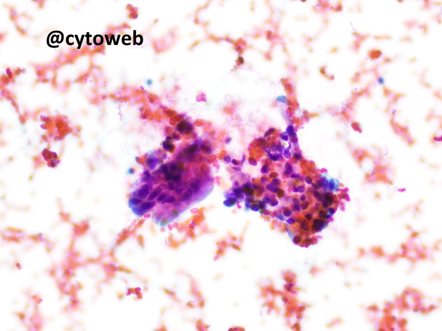 Mystery cases – EUS-FNA 6 – NUS Pathweb :: NUS Pathweb