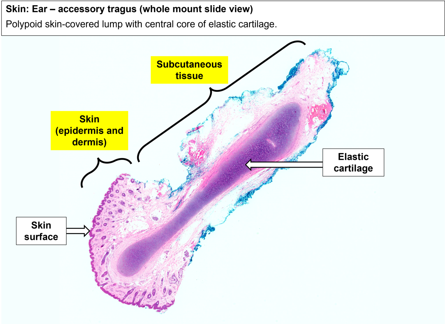 Ear – Accessory Tragus – NUS Pathweb :: NUS Pathweb