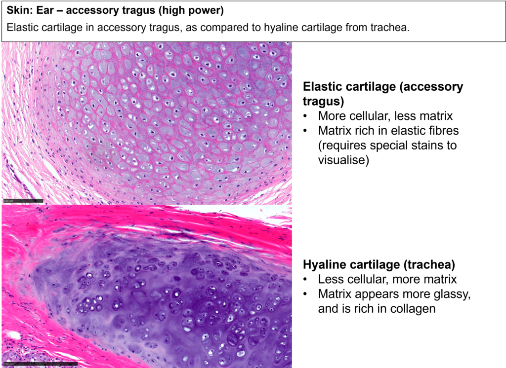Ear – Accessory Tragus – NUS Pathweb :: NUS Pathweb