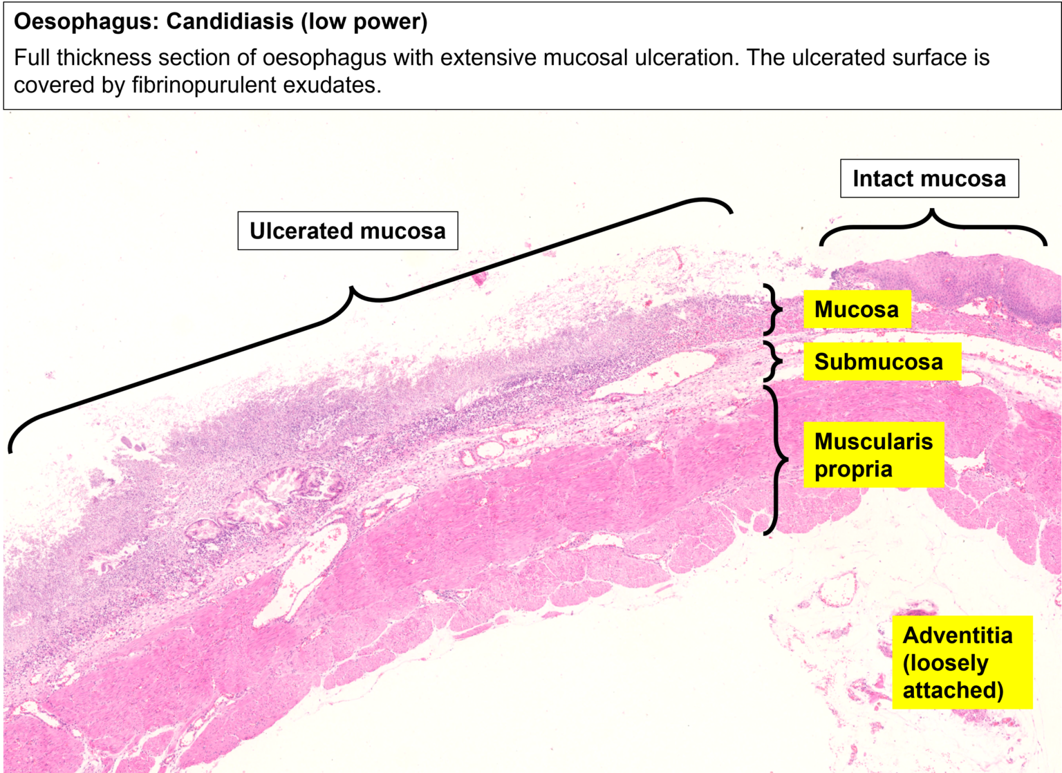 Oesophagus – Candidiasis (Moniliasis) – NUS Pathweb :: NUS Pathweb