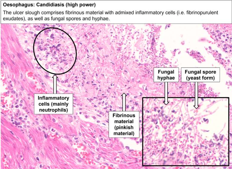 Oesophagus – Candidiasis (Moniliasis) – NUS Pathweb :: NUS Pathweb