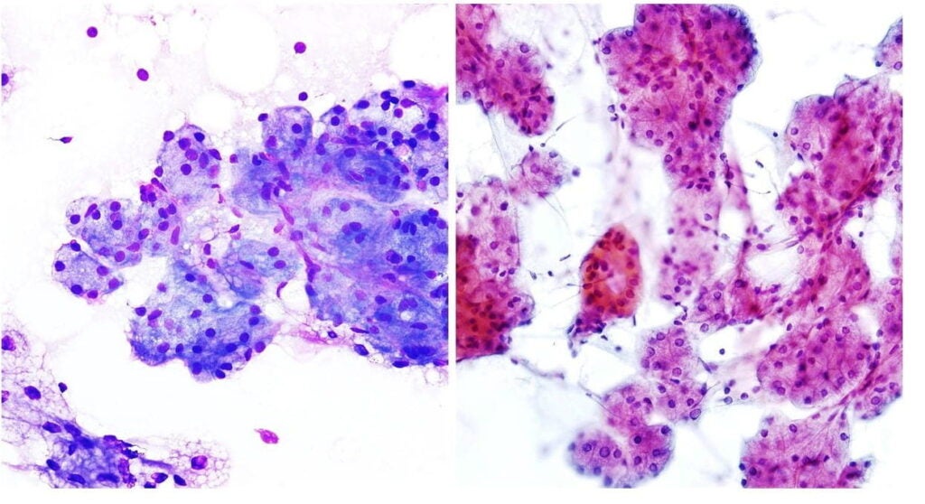 Picture Atlas – FNA: Salivary gland – NUS Pathweb :: NUS Pathweb