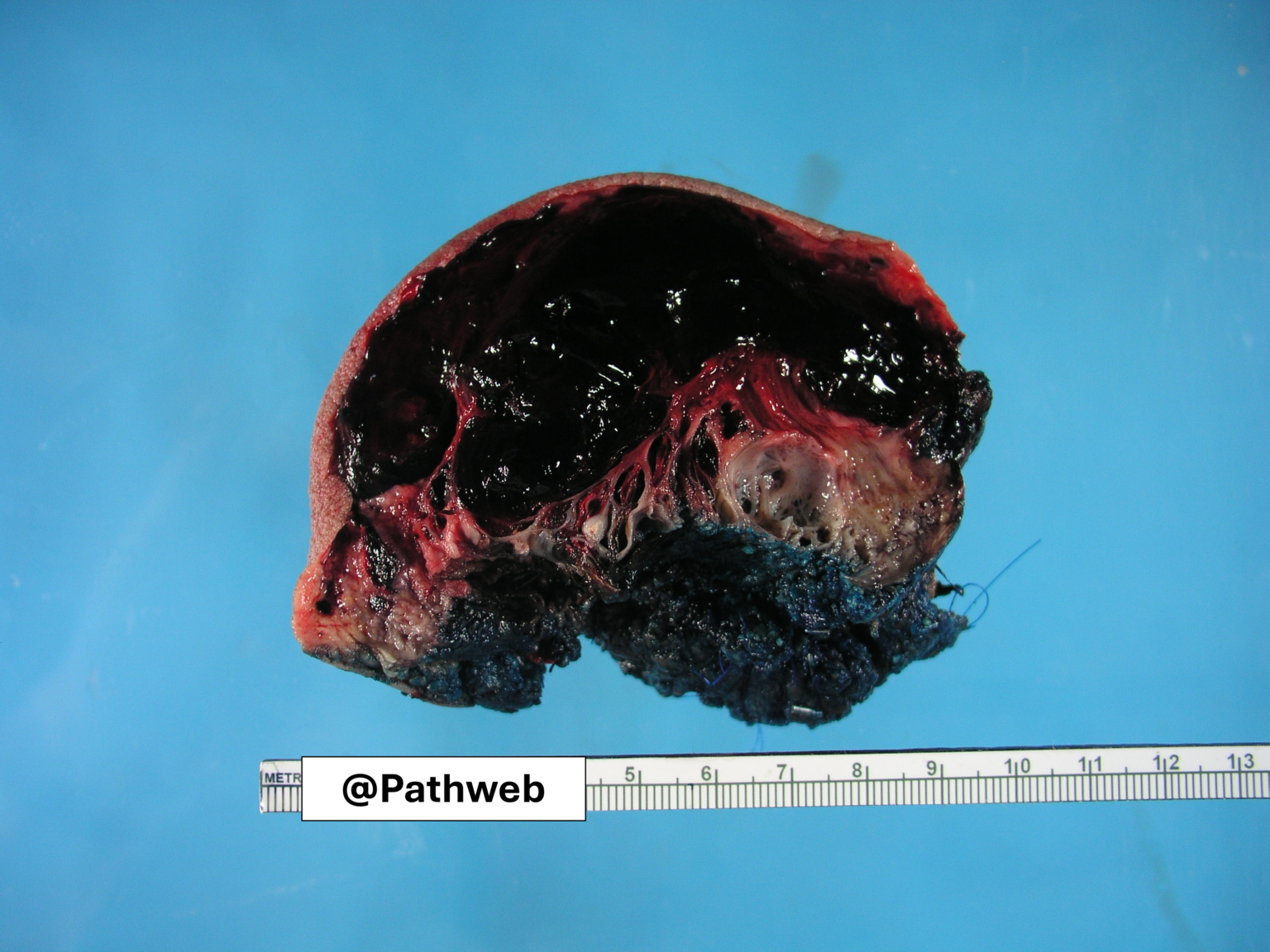 Skin – Cavernous haemangioma – NUS Pathweb :: NUS Pathweb