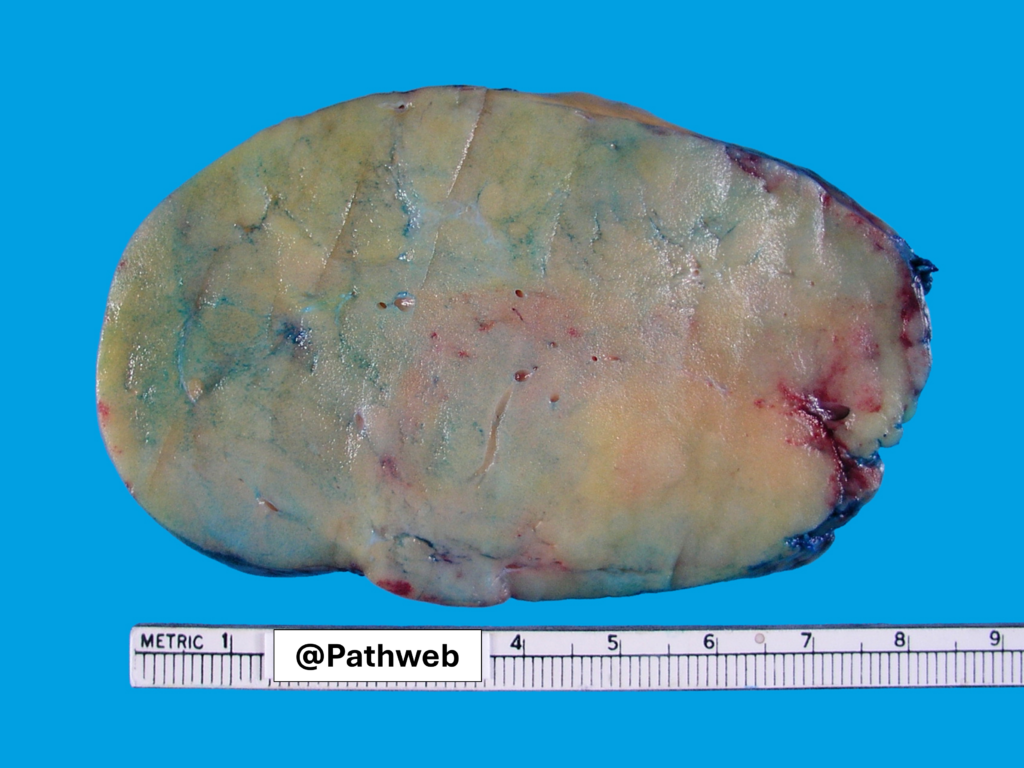 Retroperitoneum – Liposarcoma – NUS Pathweb :: NUS Pathweb