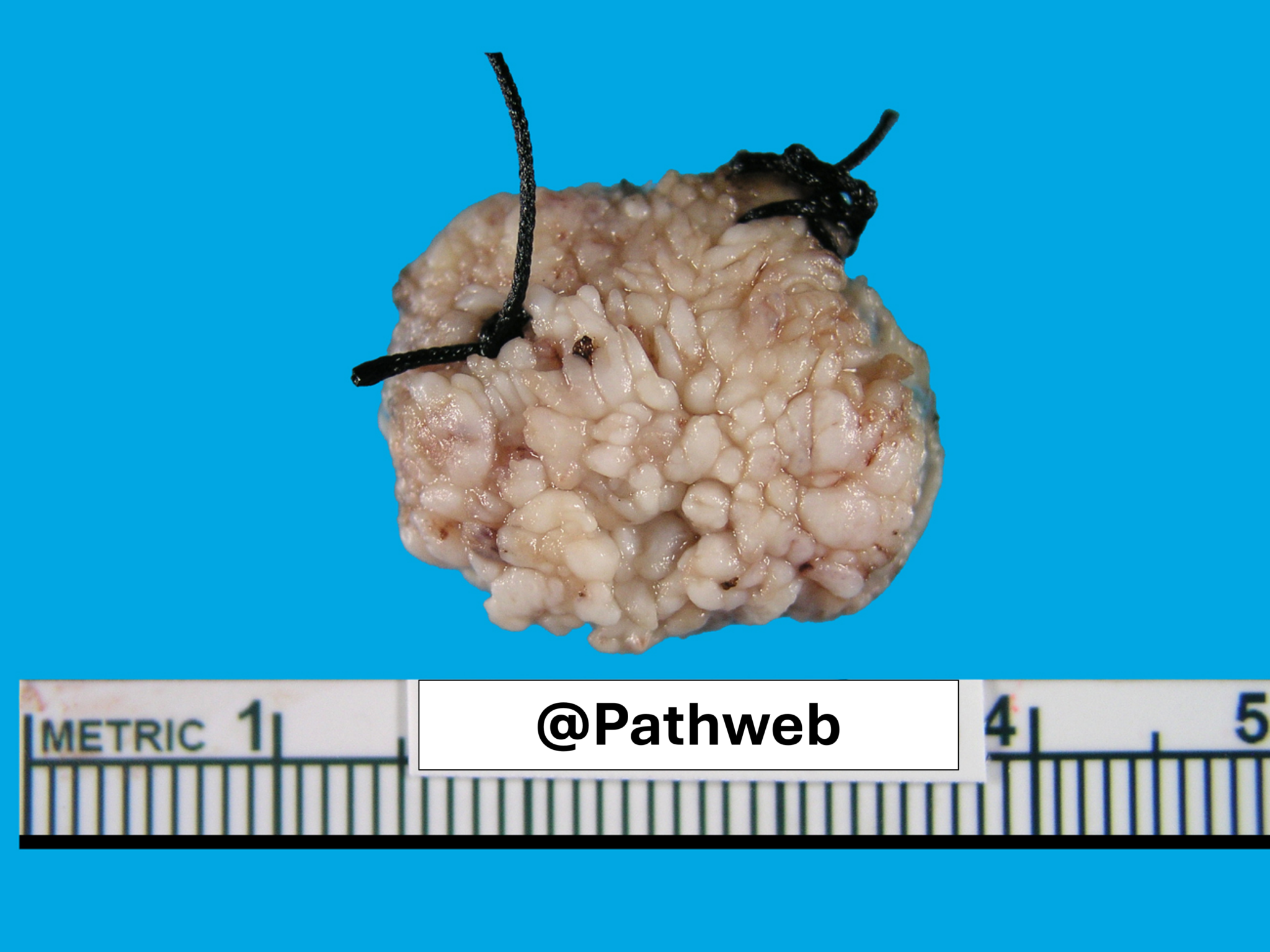 Skin_Squamous cell carcinoma (Verrucous Carcinoma) – NUS Pathweb :: NUS ...