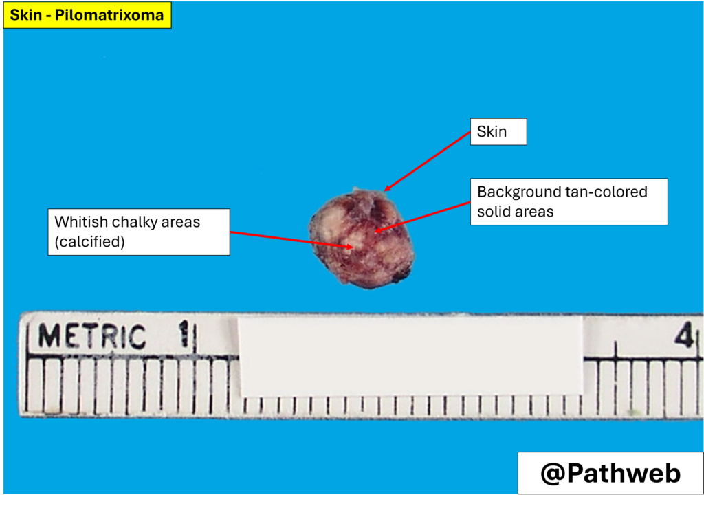 Skin – Pilomatrixoma – NUS Pathweb :: NUS Pathweb