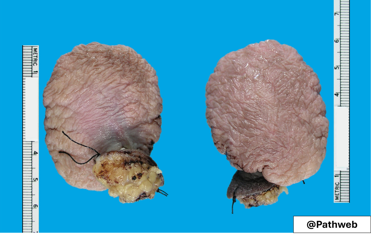 Skin – Fibroepithelial polyp – NUS Pathweb :: NUS Pathweb