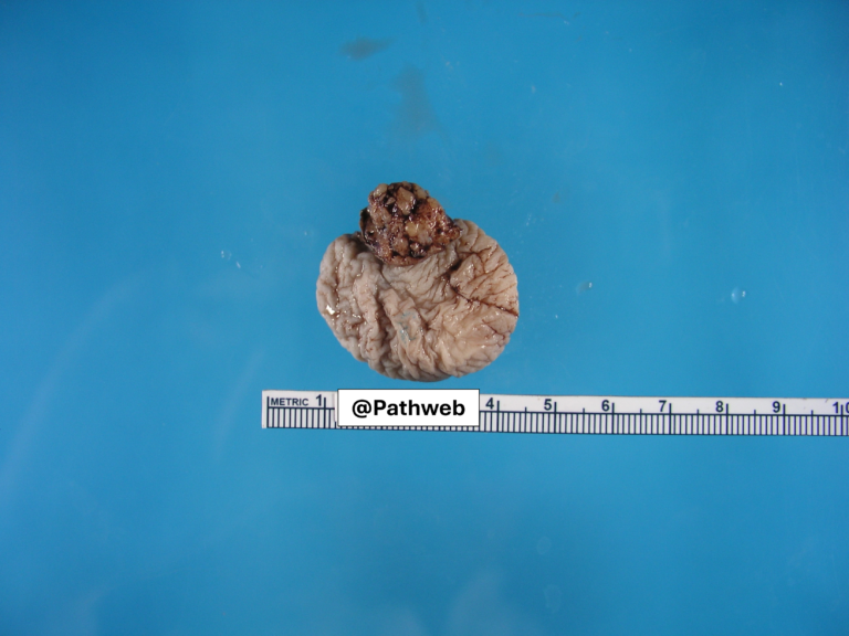 Skin – Fibroepithelial polyp – NUS Pathweb :: NUS Pathweb
