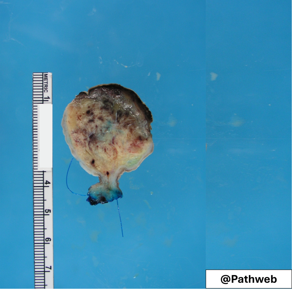 Skin – Fibroepithelial polyp – NUS Pathweb :: NUS Pathweb