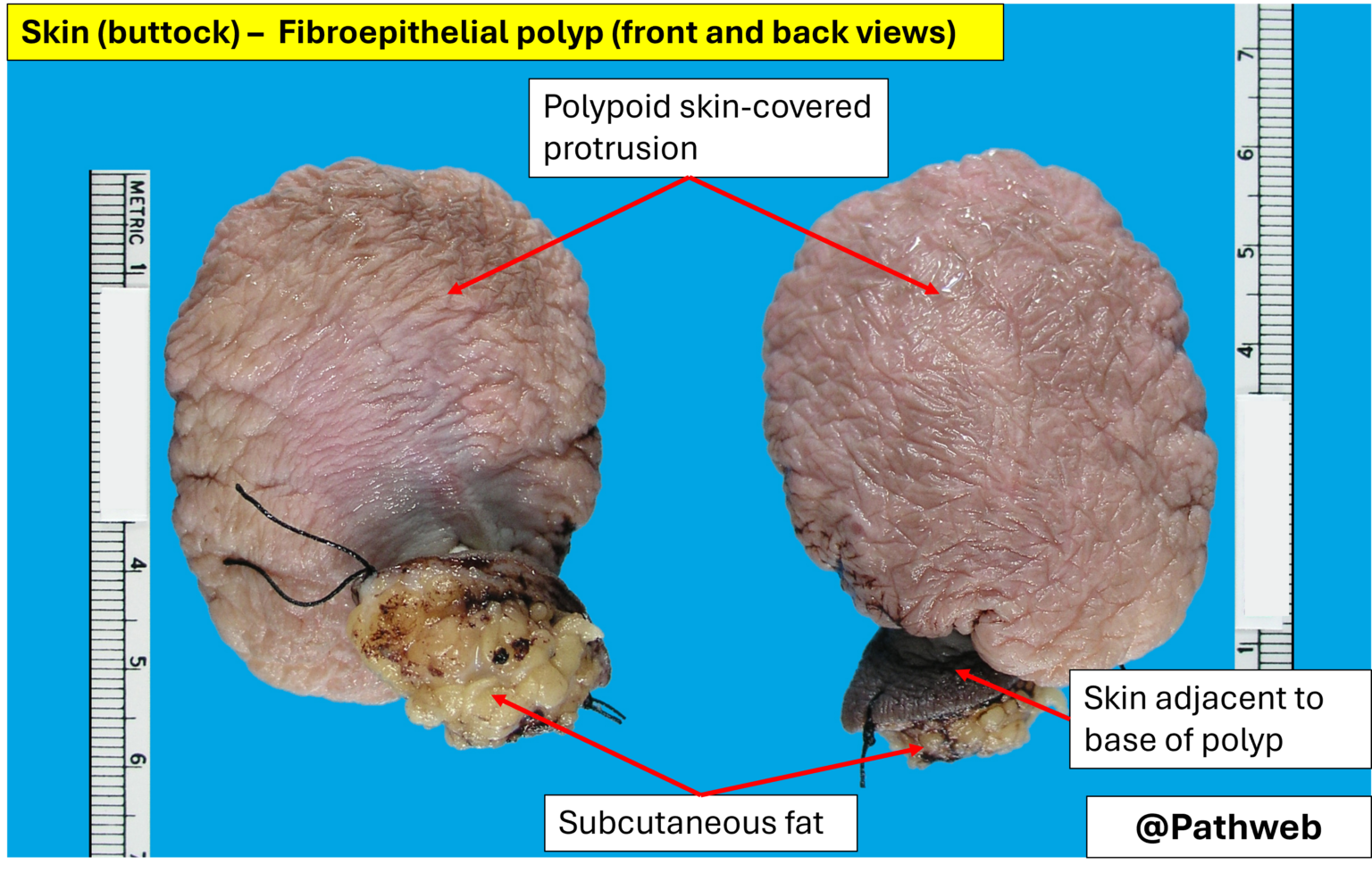 Skin – Fibroepithelial polyp – NUS Pathweb :: NUS Pathweb