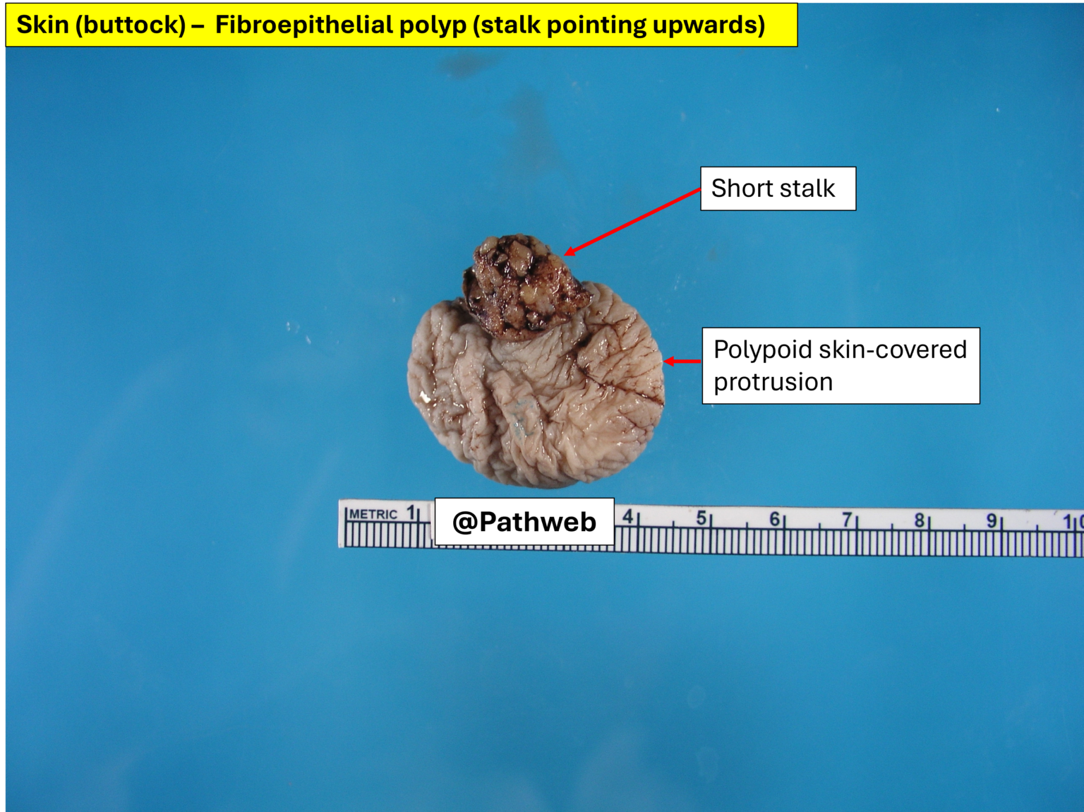 Skin – Fibroepithelial polyp – NUS Pathweb :: NUS Pathweb
