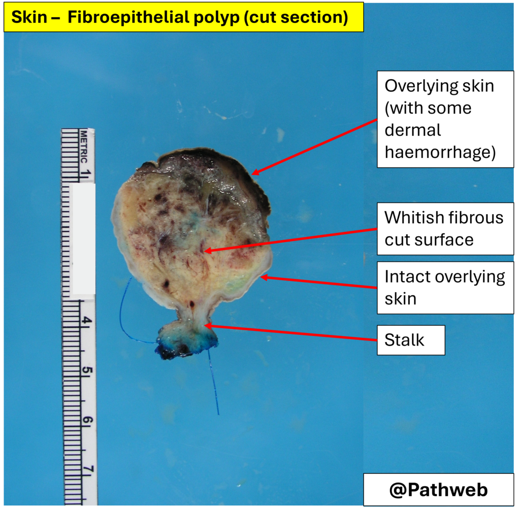 Skin – Fibroepithelial polyp – NUS Pathweb :: NUS Pathweb
