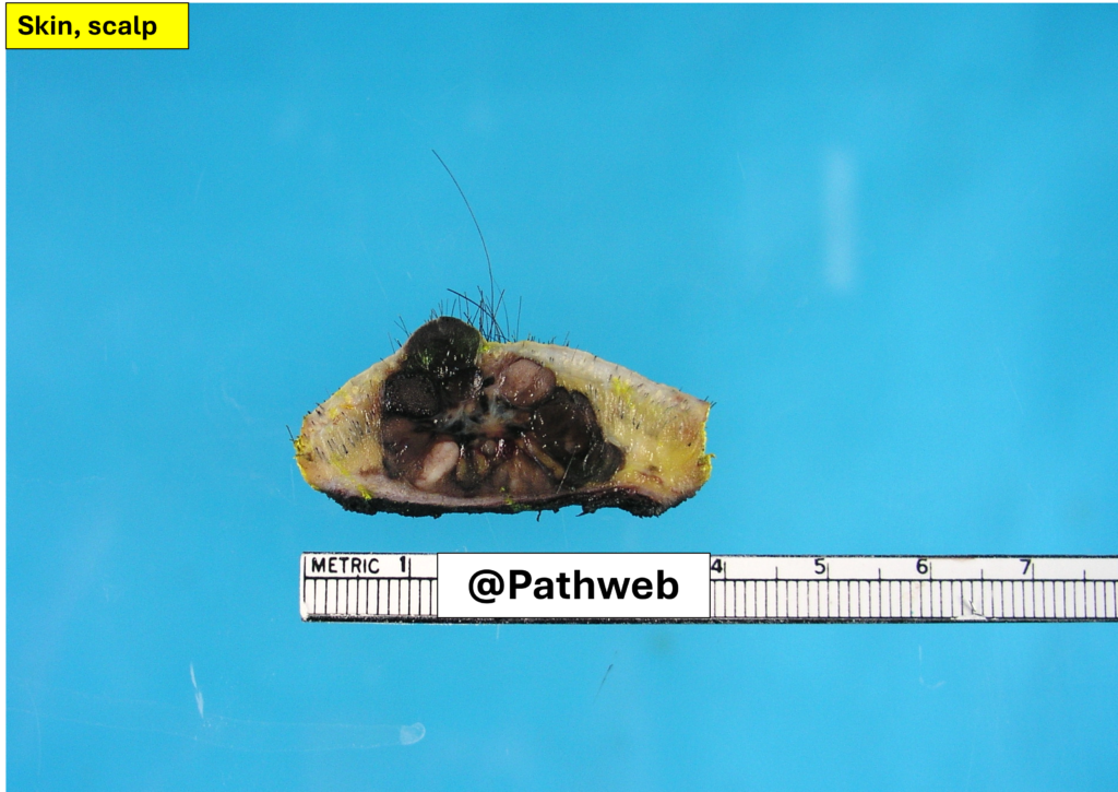 TYDS Gross Case 13 – NUS Pathweb :: NUS Pathweb