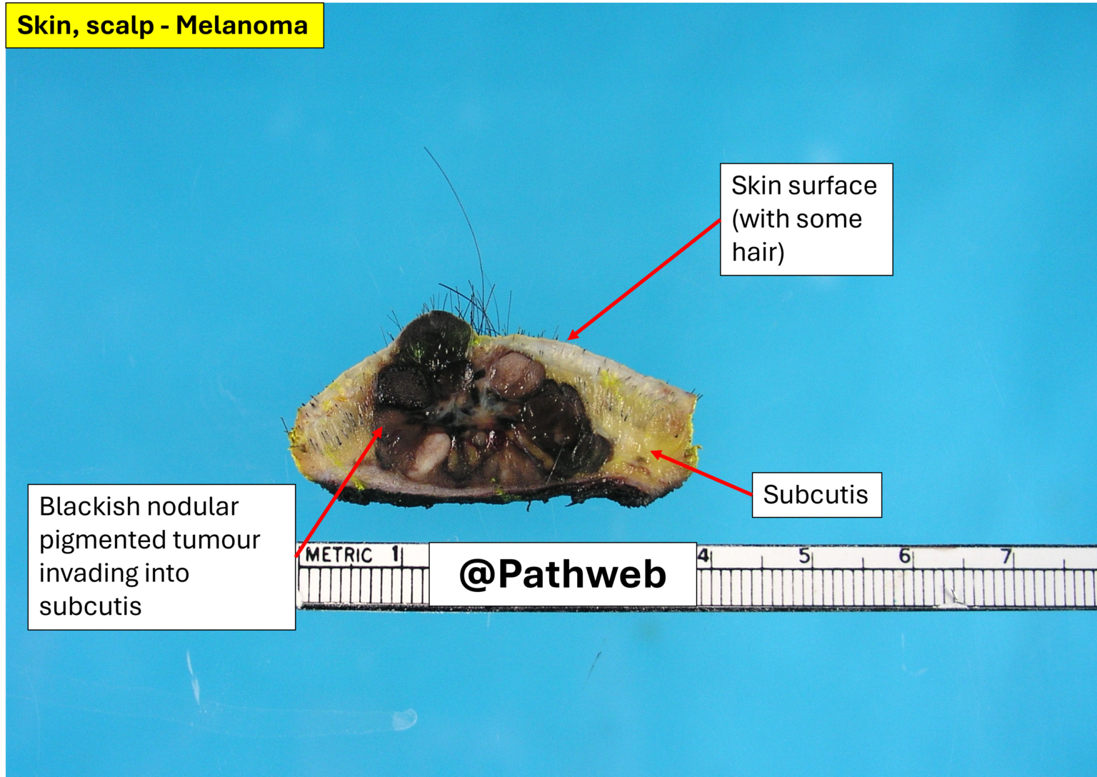 TYDS Gross Case 13 – NUS Pathweb :: NUS Pathweb