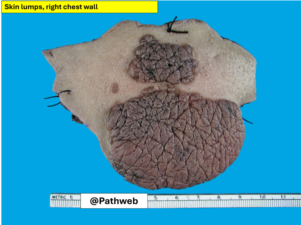 TYDS Gross Case 14 – NUS Pathweb :: NUS Pathweb