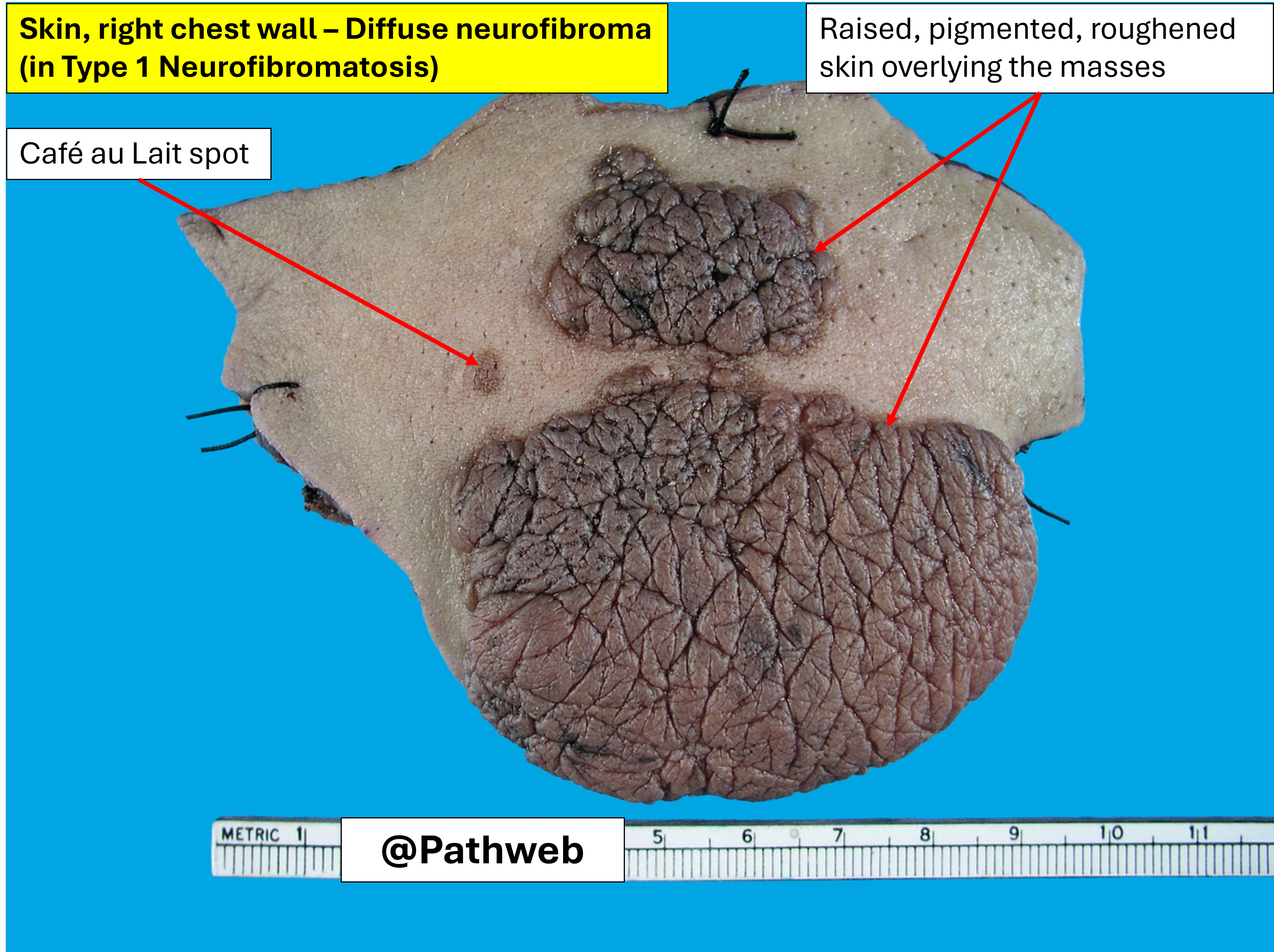 TYDS Gross Case 14 – NUS Pathweb :: NUS Pathweb