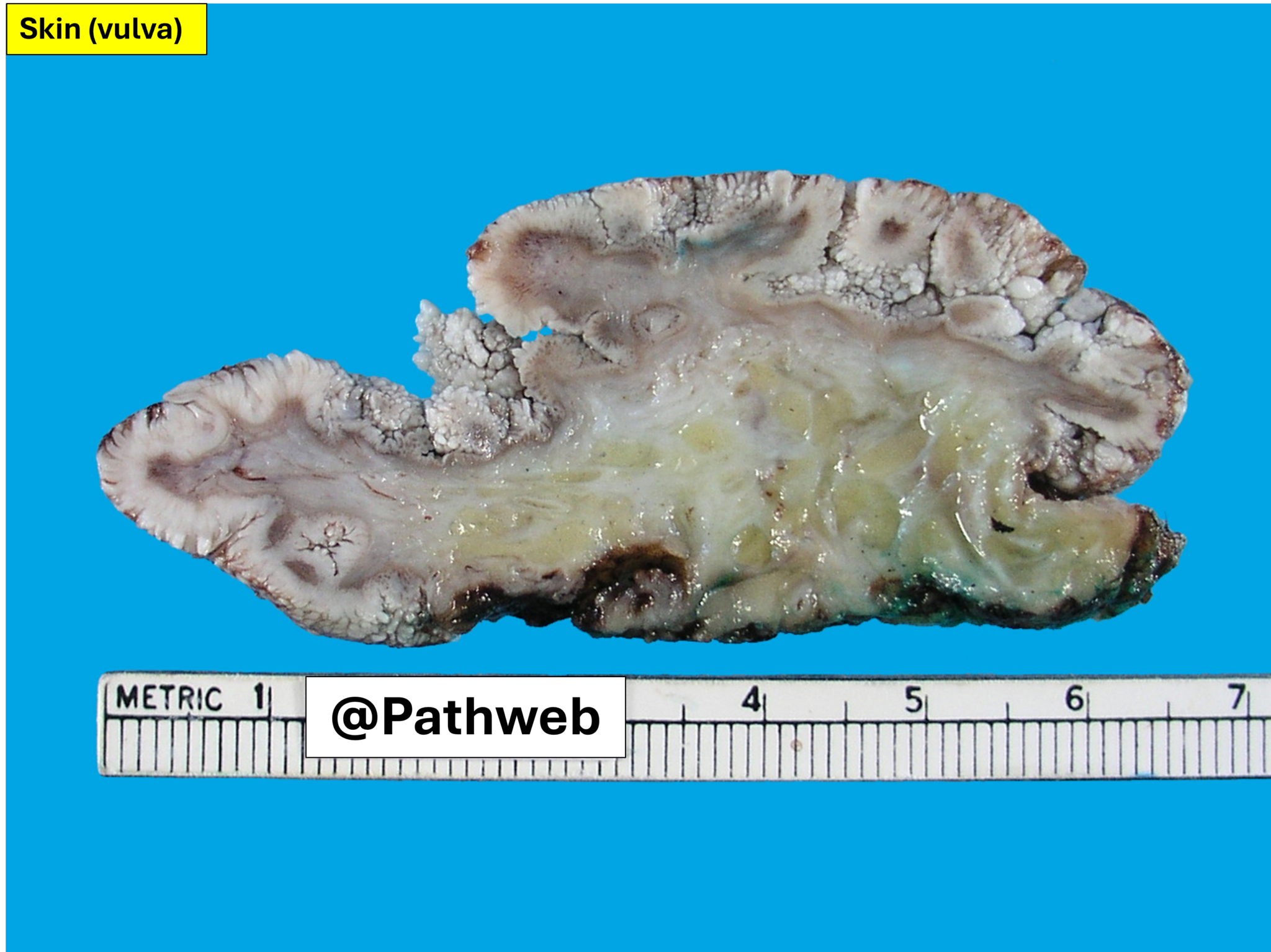 TYDS Gross Case 6 – NUS Pathweb :: NUS Pathweb